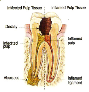 Endodontics (Nerve Treatment) – Kharinta Dental Clinic